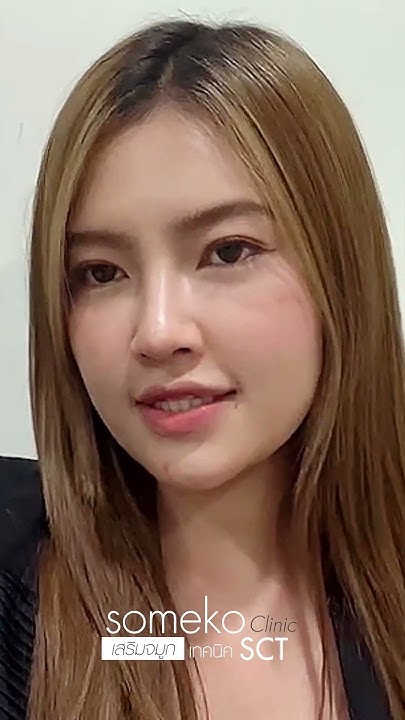 รีวิวเสริมจมูกครบ 15 วัน บวมช้ำน้อยมาก!! #เสริมจมูก #someko - YouTube