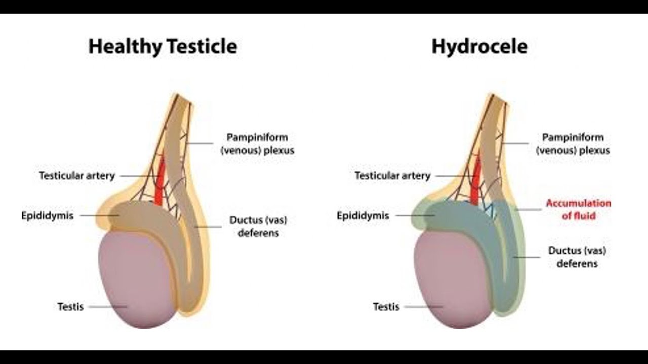Epididymal Cyst Treatment Youtube