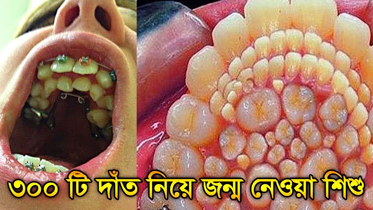 মুখে ৩০০ দাঁত! নিয়ে জন্মে ছিল এই ছেলে । This Kid Was Born With 300 ...
