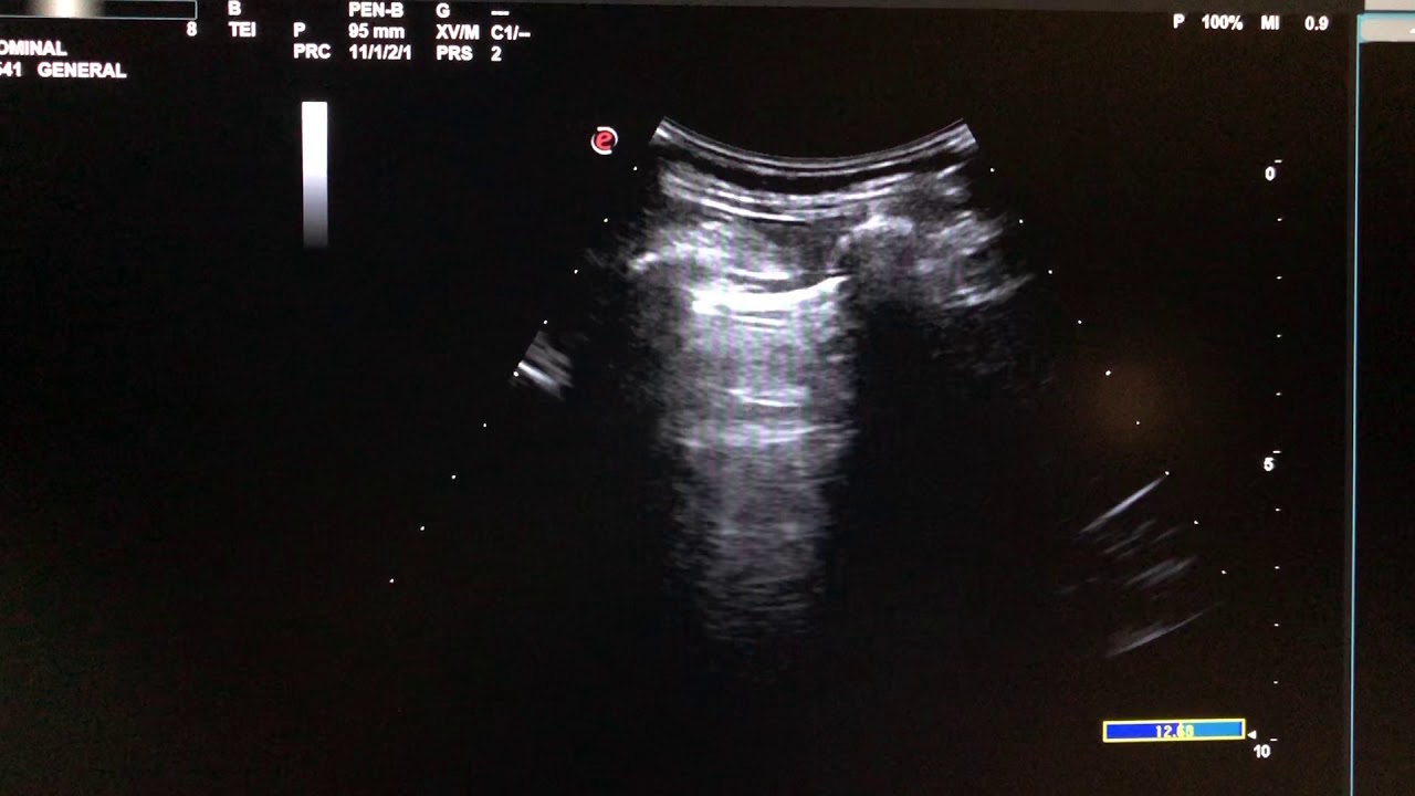 Ecografia de tórax. Chest ultrasound. - YouTube