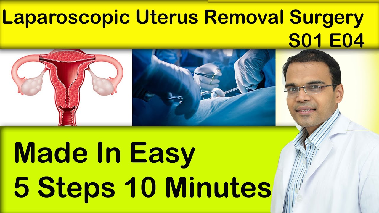 Laparoscopic Uterus Removal Surgery S01 E04 Made In Easy 5 Steps 10 ...