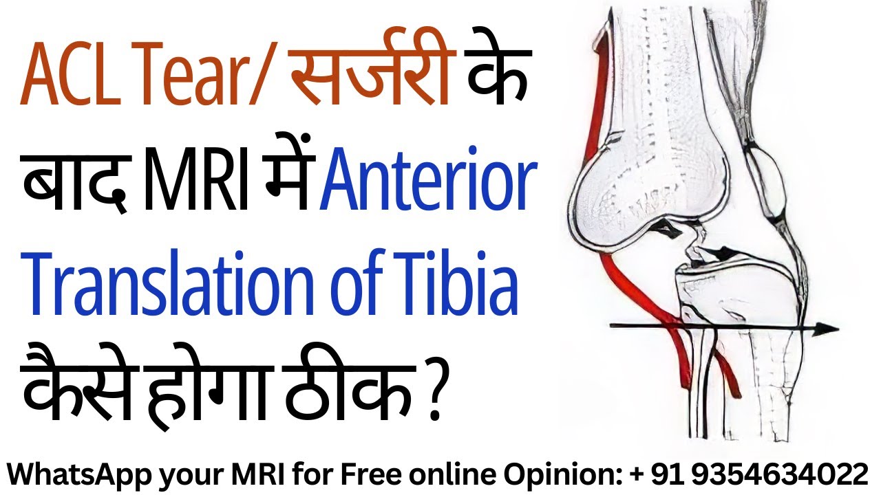 ACL Tear/ सर्जरी के बाद Anterior Translation of Tibia कैसे होगा ठीक ? Bio ACL Surgery Bone ...