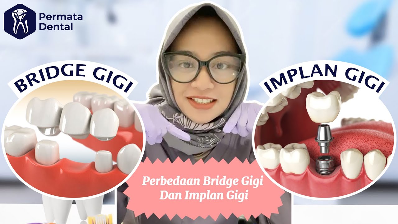 Perbedaan Bridge Gigi dan Implan Gigi | Klinik Gigi Permata Dental ...