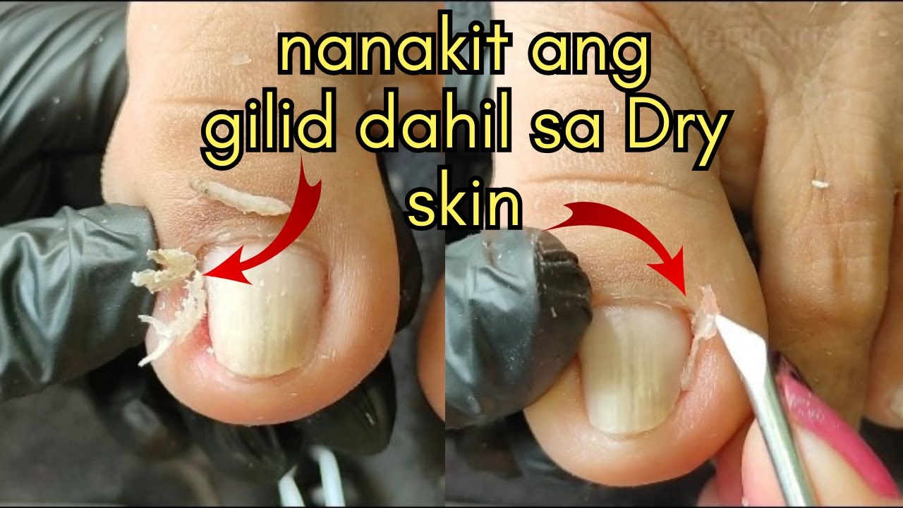 Vlog 812|Dry Skin/Ingrown Removal| PEDICURE 712 - YouTube
