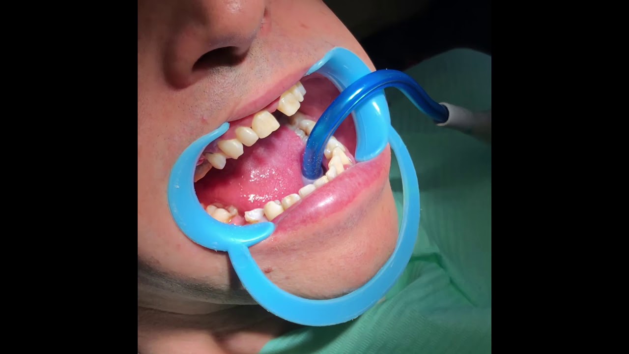 Pre-endo-prep and Er:YAG laser cavitation after root canal treatment ...