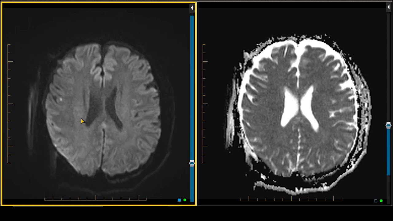 Post op Subdural Hematoma, Tentorial Hematoma MRI Online - YouTube