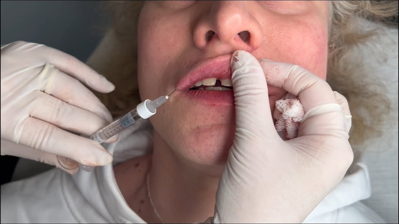 Professional Lip Filler Injection Guide: Safe & Effective Technique ...