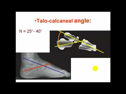 Foot and ankle angles in plain radiograph Prof Dr Tarek Goda - YouTube