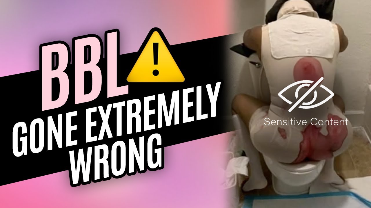 Thinking of getting BBL? The Nightmares: You Need to Know the Risks ...