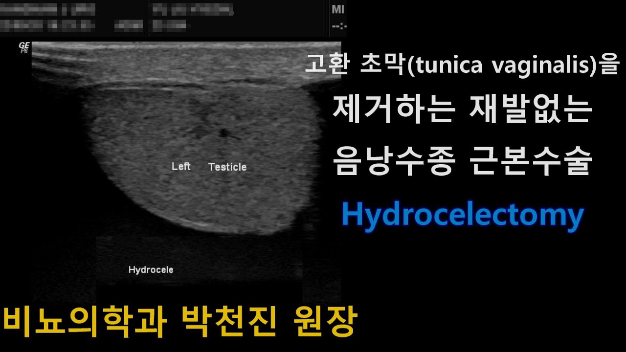고환 초막(tunica vaginalis)을 제거하는 재발없는 음낭수종 근본수술 Hydrocelectomy - YouTube