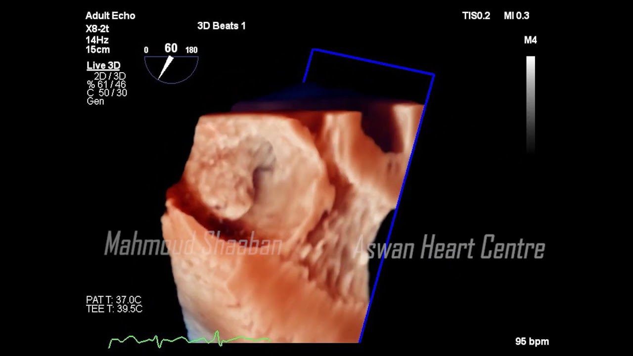 Unpleasant surprise during pre-PMC TEE assessment in a patient with ...