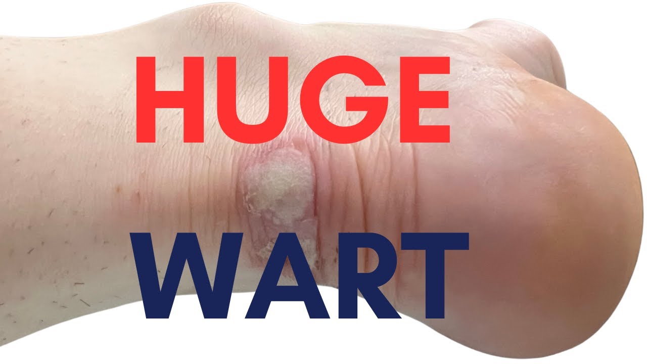 Swift microwave wart treatment is highly effective and does not require ...