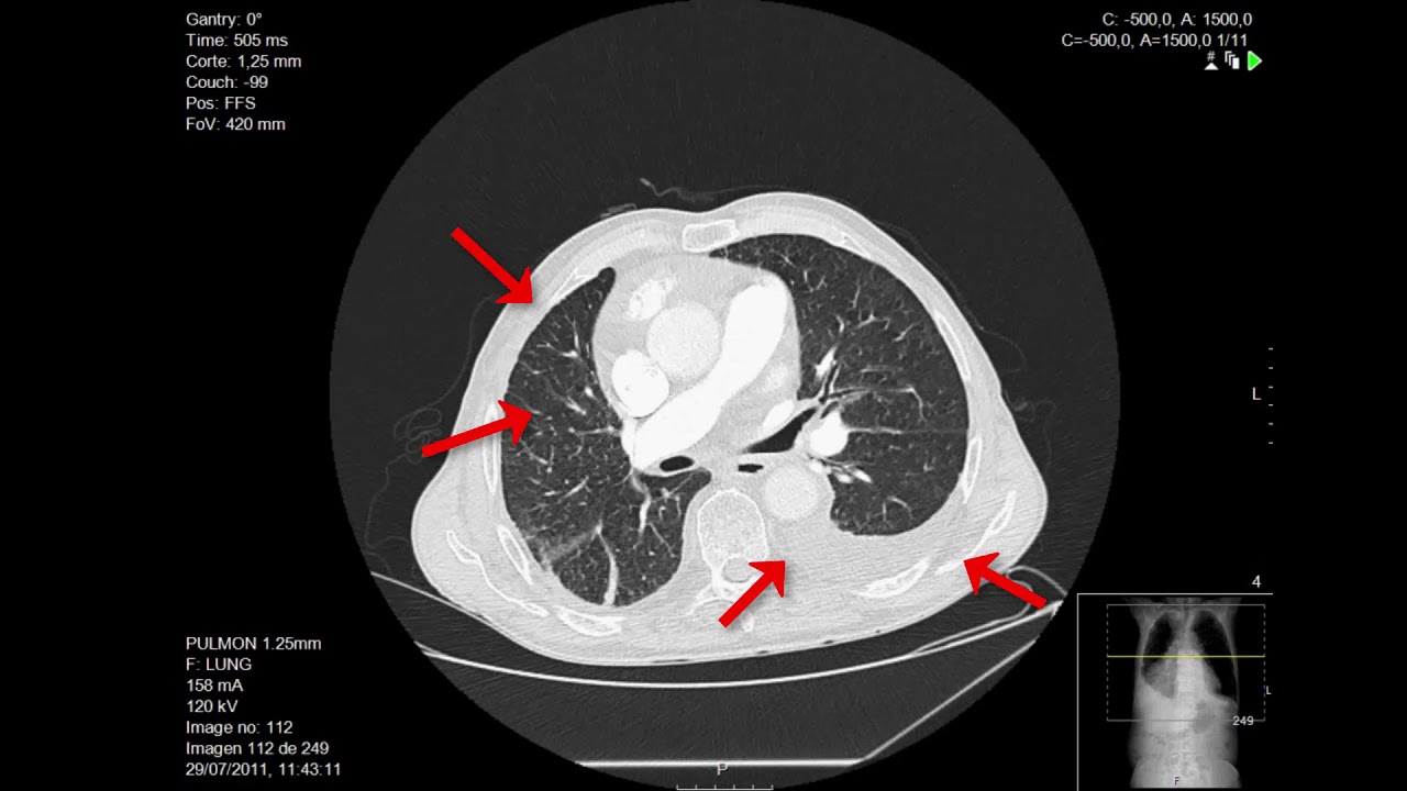 Radiografia De Derrame Pericardico MediClases Fácil