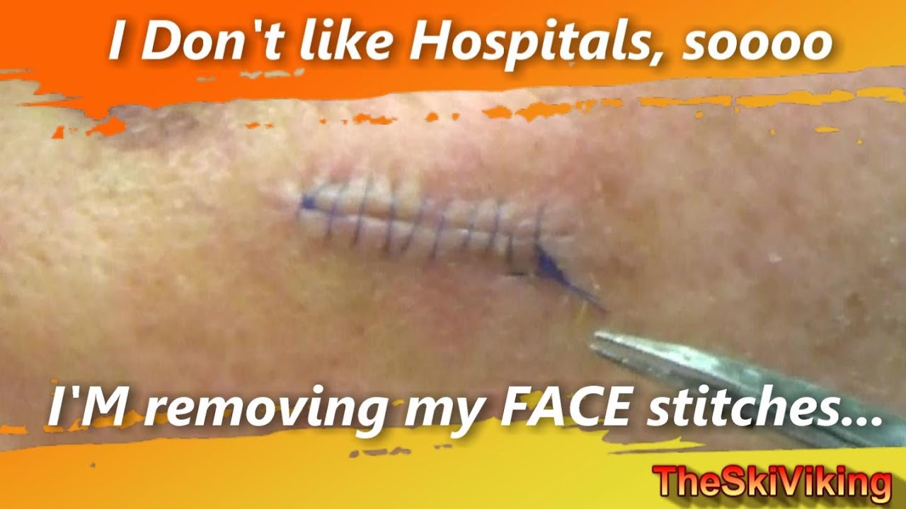 Pulling Out Stitches From My Own Face - YouTube