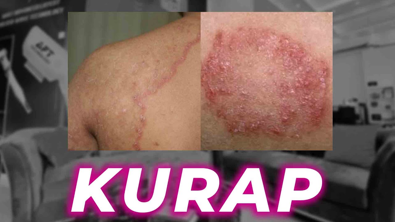 What is Ringworm (Kurap) ? - YouTube