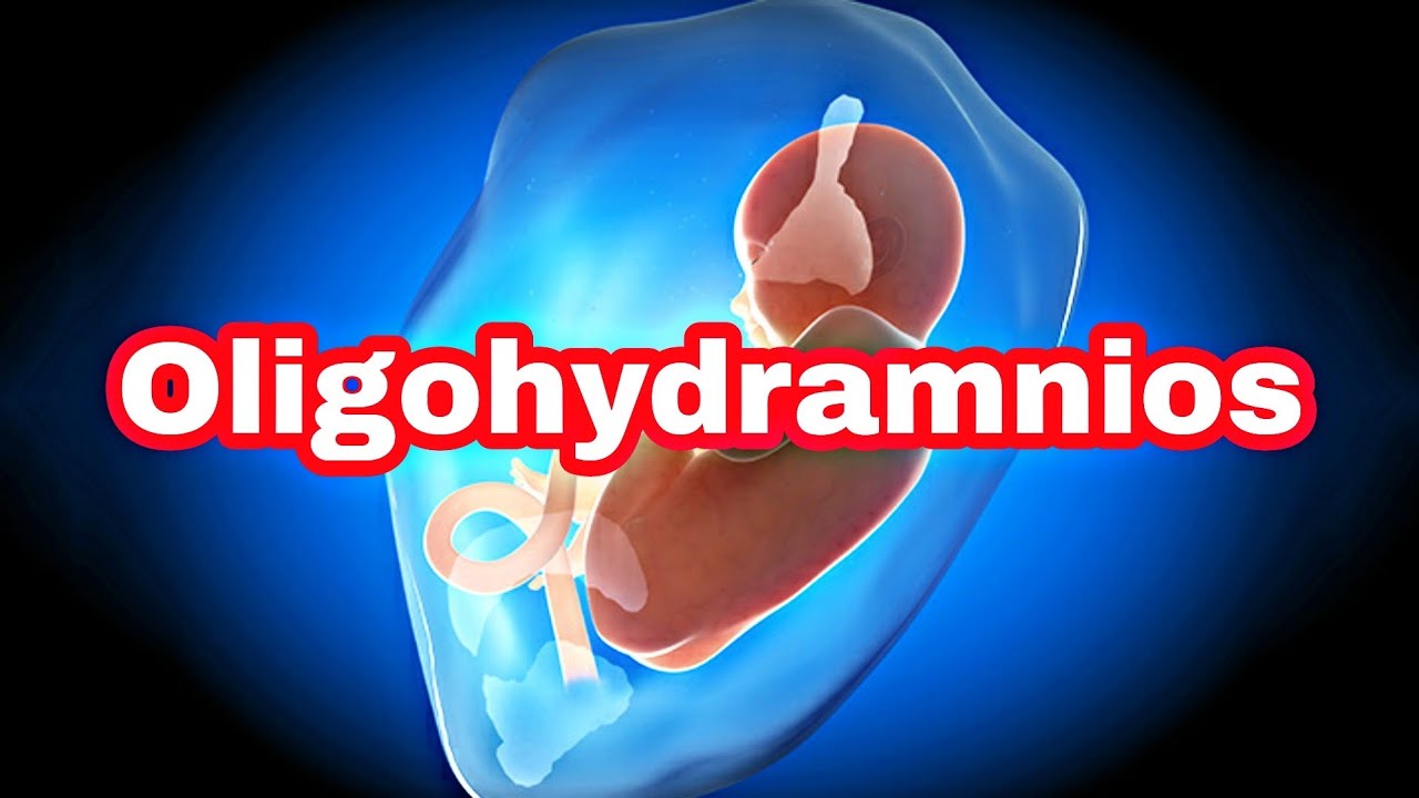 Oligohydramnios|Causes Riskfactors|Diagnosis|Complications|Management ...