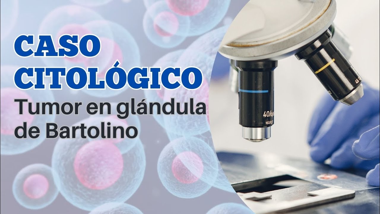 Tumor en Glándula de Bartolino. - YouTube