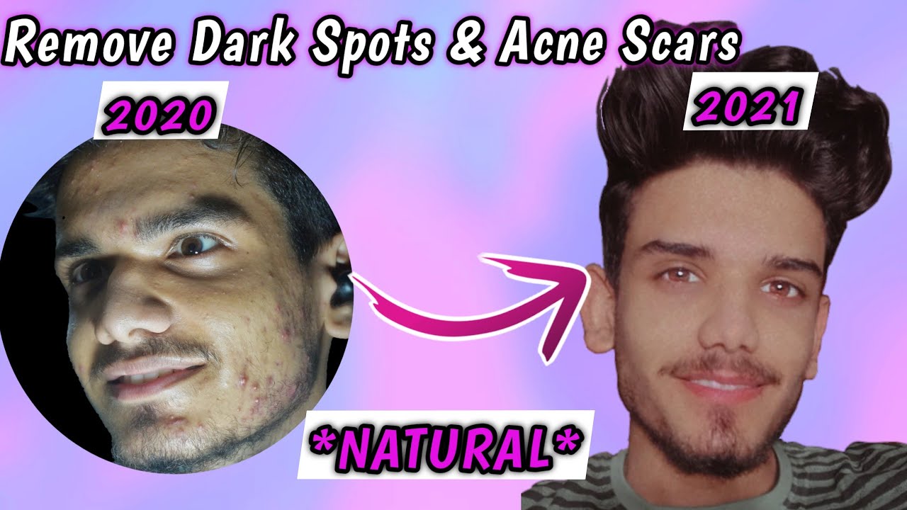 How To Remove Dark Spots And Scars on Face NATURALLY | Face par se DARK ...