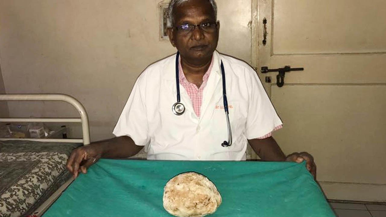 Doctor Removes Huge Bladder Stone - YouTube