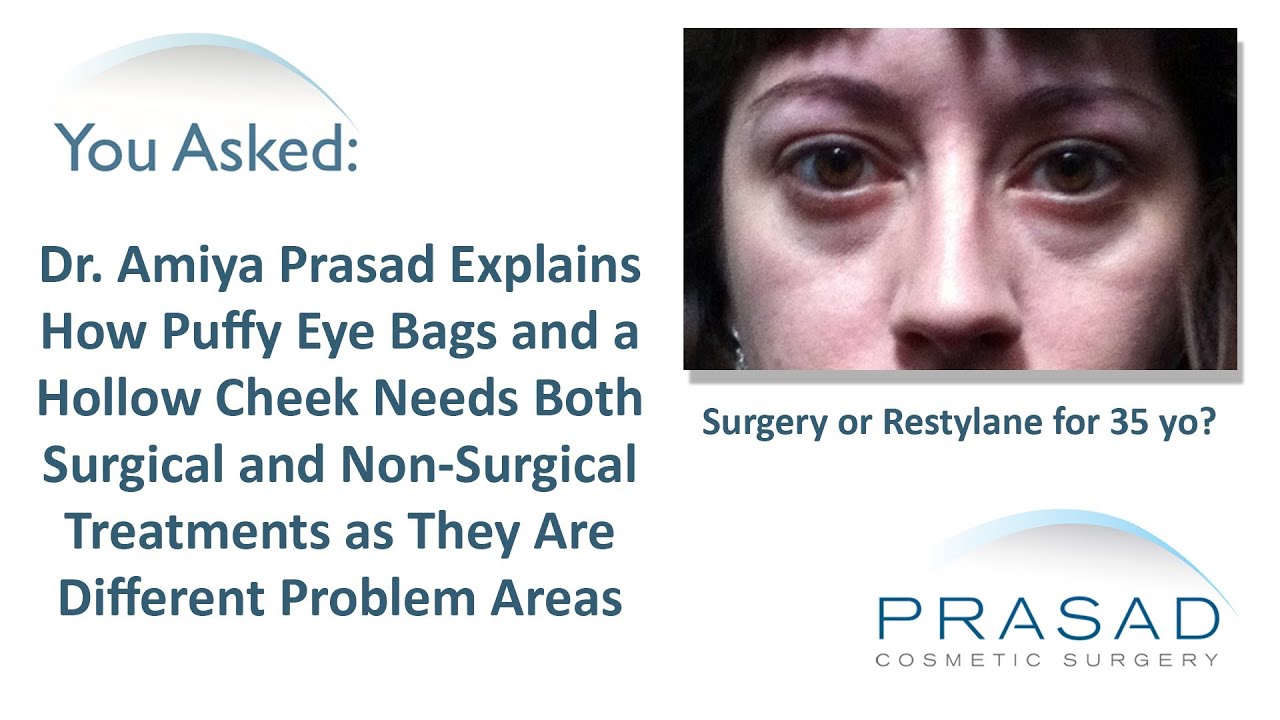 How Slightly Puffy Eyes Can be Treated with Fillers, & Addressing the ...