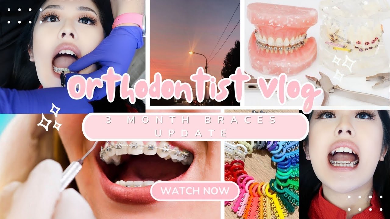 BRACES VLOG EP.5: 3 MONTH BRACES UPDATE + GOOD NEWS!?, wire changed ...