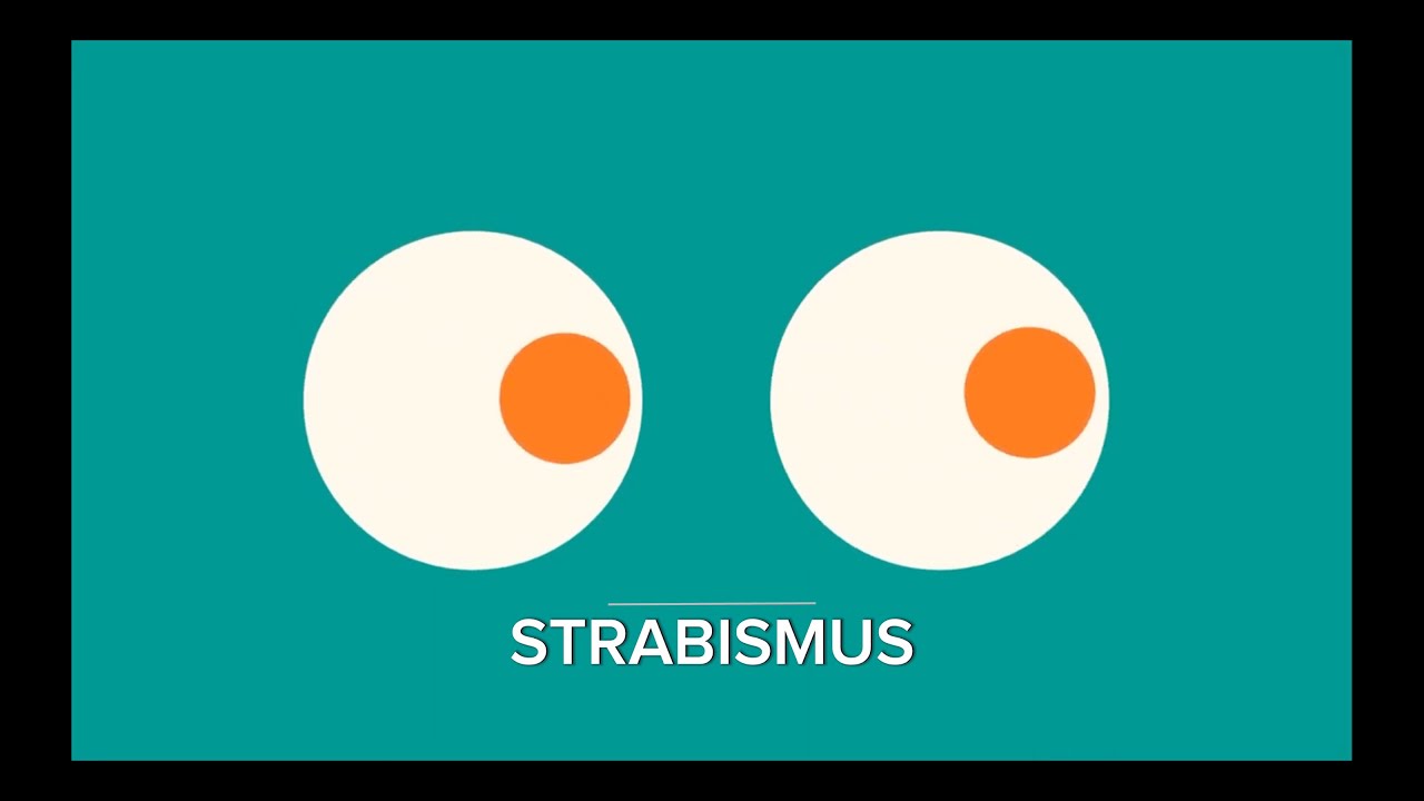 Video Edukasi Strabismus dan Penanganannya by Rani Ramzi - YouTube