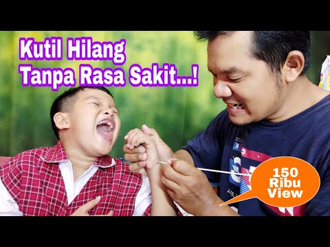 CARA MENGHILANGKAN KUTIL