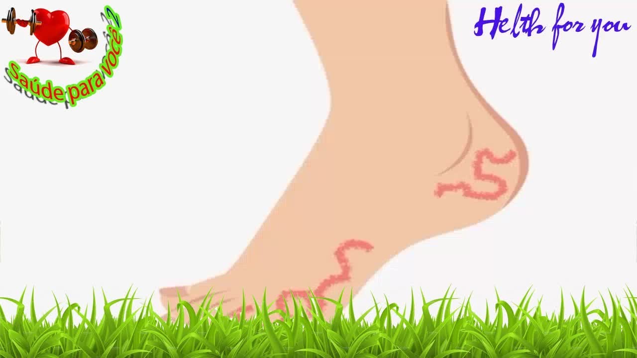 Saúde 2 - Como saber se é bicho geográfico - YouTube