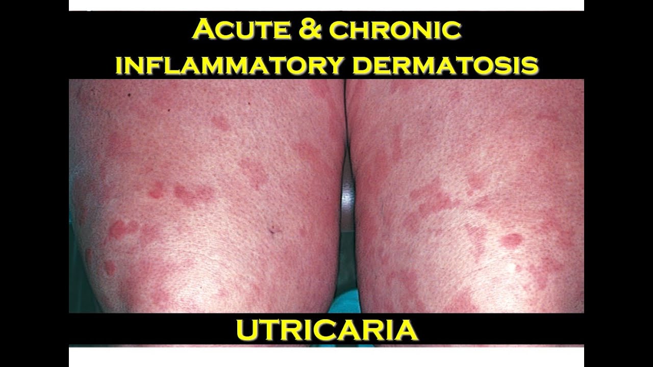3a - Intro of inflammatory dermatosis & Utricaria - YouTube