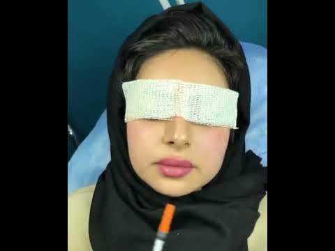 شاهد عمليه حقن الوجه فلر وجنات نضاره تغير جمال شامل - YouTube