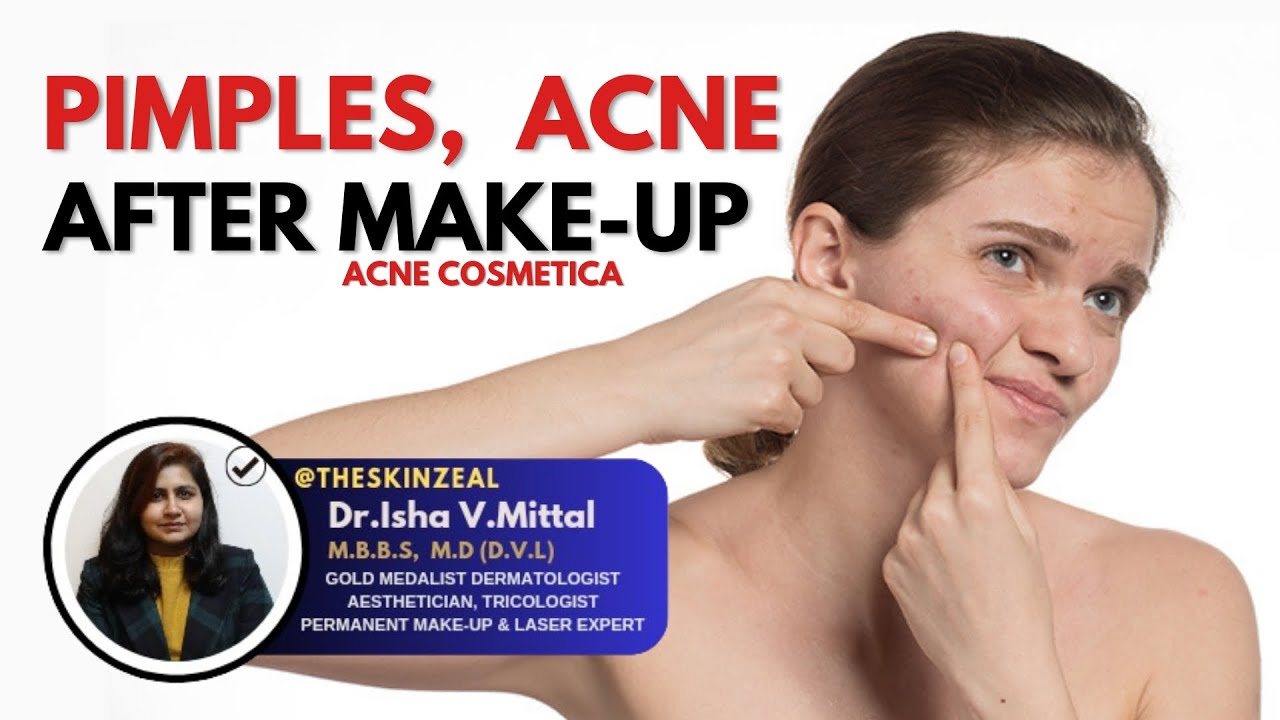 Pimples After Make-Up | Acne prone skin | Dr.Isha V.Mittal | The Skin ...