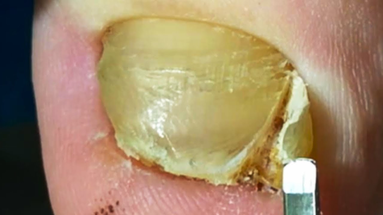 Wow, I Dug A Huge Dirt Hole Under My Toenails!【Crazy pedicure room ...