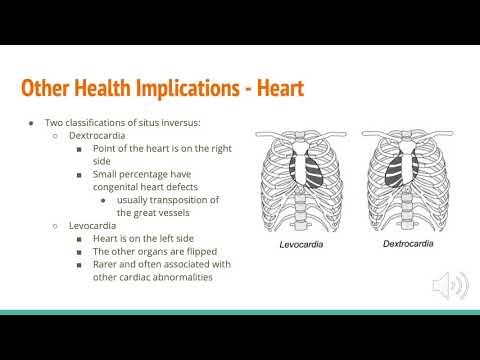 Situs Inversus   Presentation 4