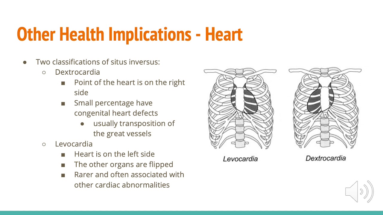 Situs Inversus Presentation 4 - YouTube