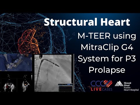M-TEER using MitraClip G4 System for P3 Prolapse - YouTube