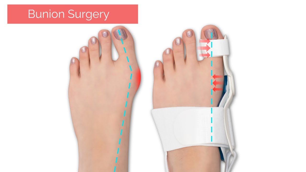 Bunion Surgery | Bunion Correction in 3D Animation | - YouTube