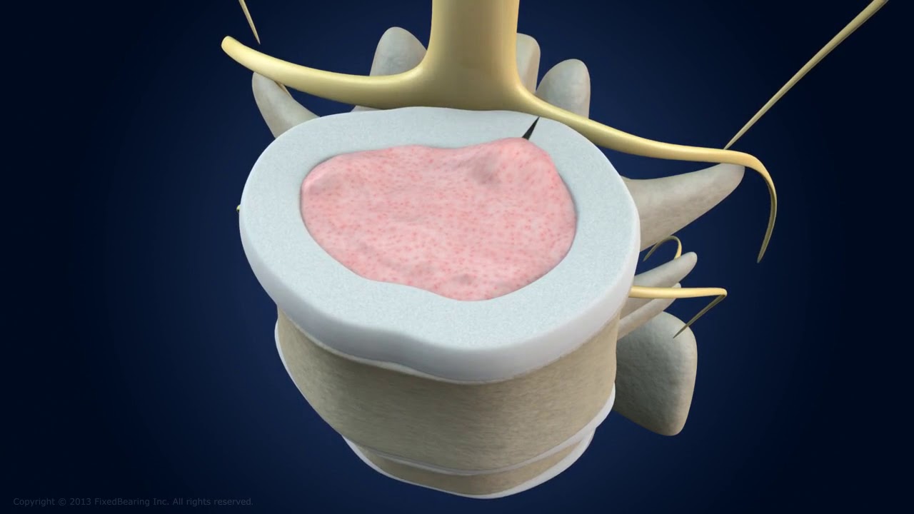 Les effets de la décompression vertébrale ou neurovertebrale - YouTube