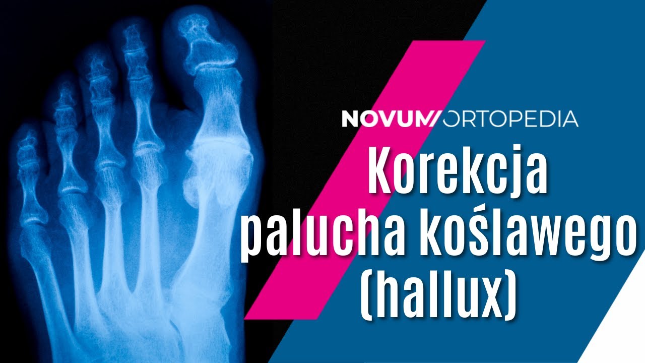 Jak leczyć HALLUXY - operacja korekcji Palucha Koślawego | Novum ...