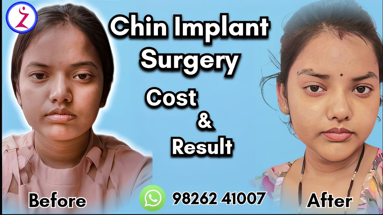 Chin Implant Surgery In Mumbai | Cost Of Chin Implant Surgery In Mumbai ...