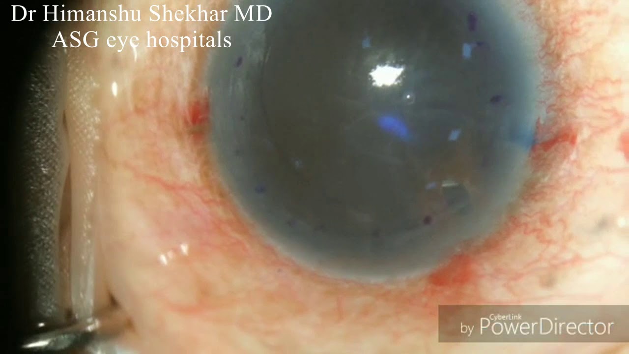 DSEK surgery for corneal decompensation - YouTube