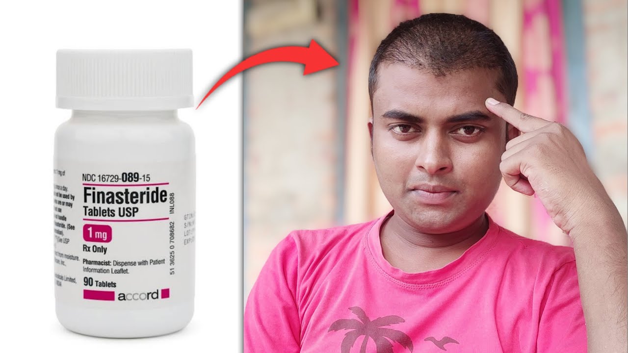 Hair Transplant ke Baad Finasteride: Mere Personal Experience ...