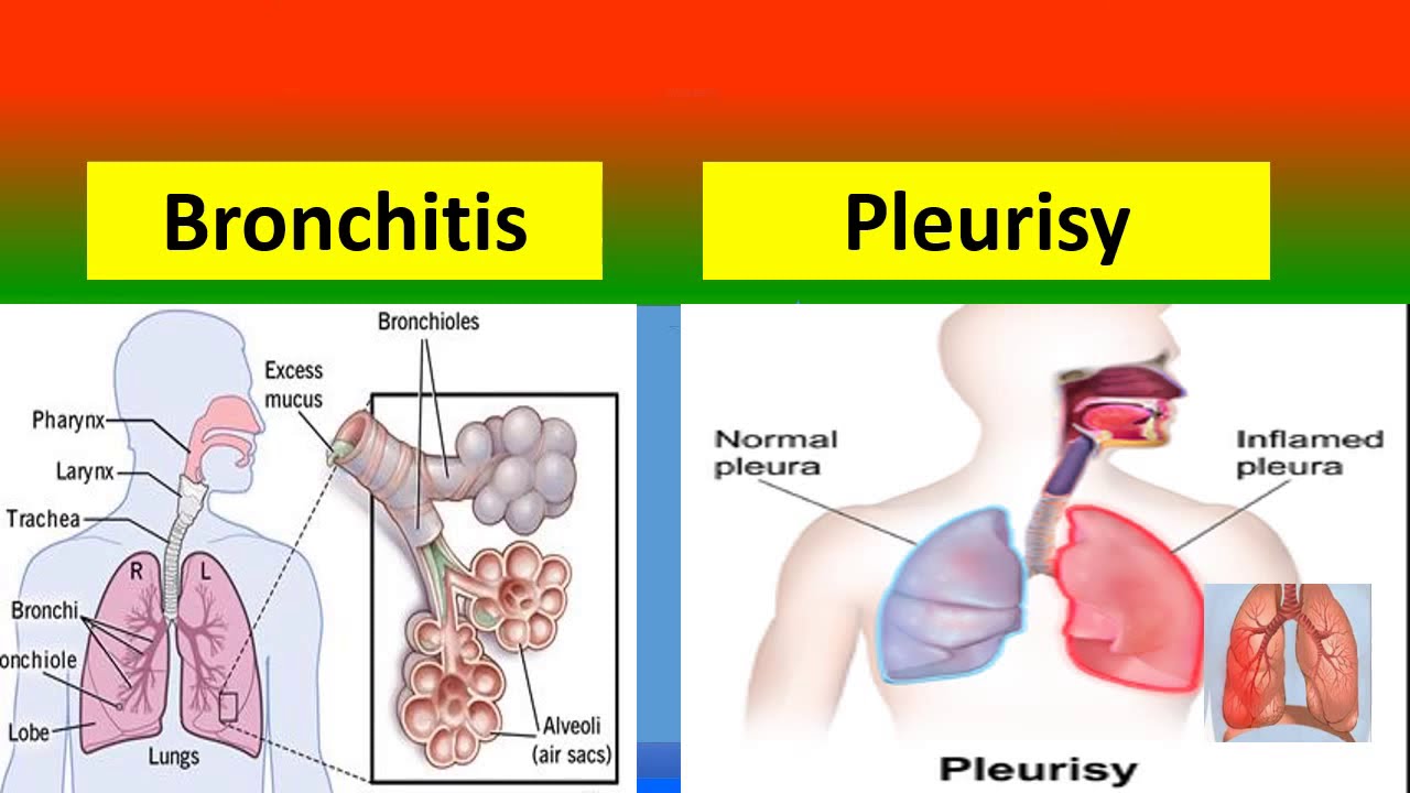 Difference Between Bronchitis and pleurisy - YouTube