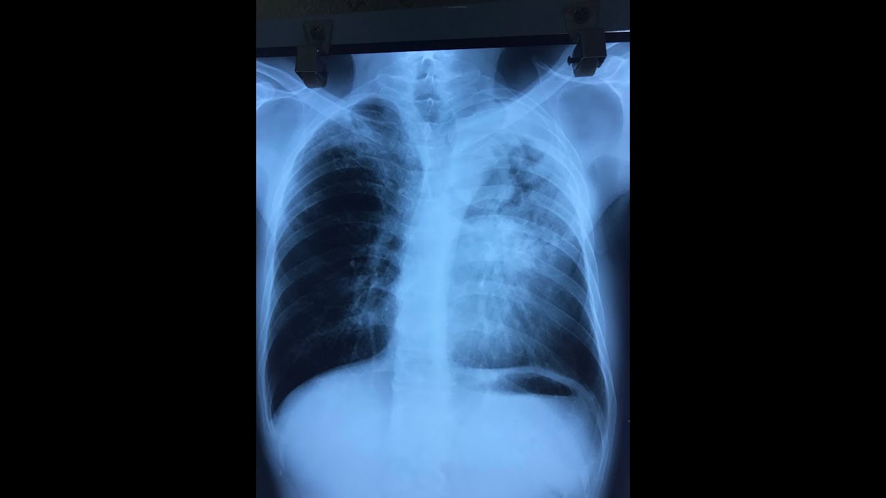Xẹp phổi/ TD Lao phổi - YouTube