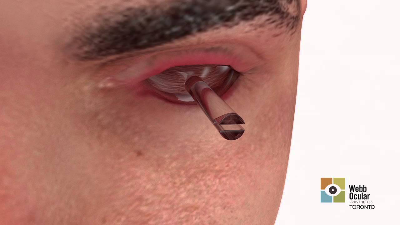 Use of the La Fuente pressure mask in a contracted socket - YouTube