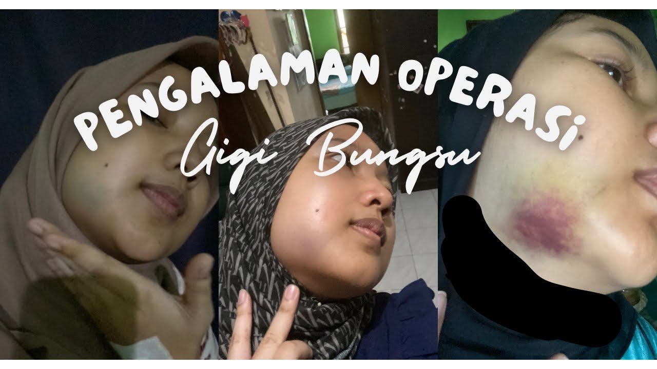 Pengalaman Operasi Gigi Bungsu dan Bisa Menggunakan BPJS - YouTube
