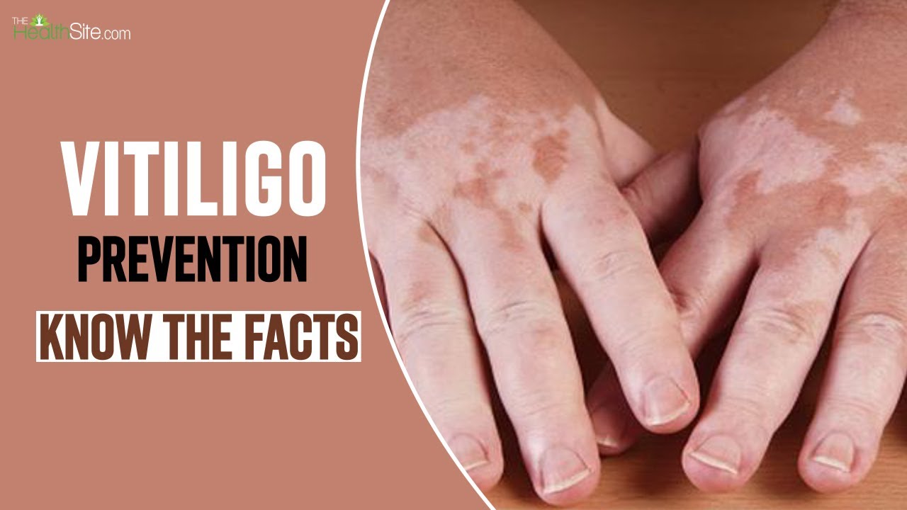 Vitiligo Disease: Types, Symptoms, Causes Treatment and Recovery | What ...