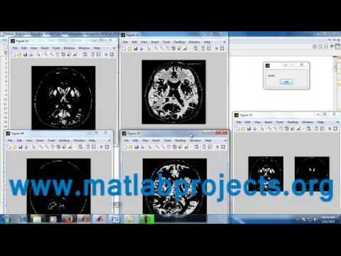 Brain MS Segmentation Image Proceesing Matlab Projects - YouTube
