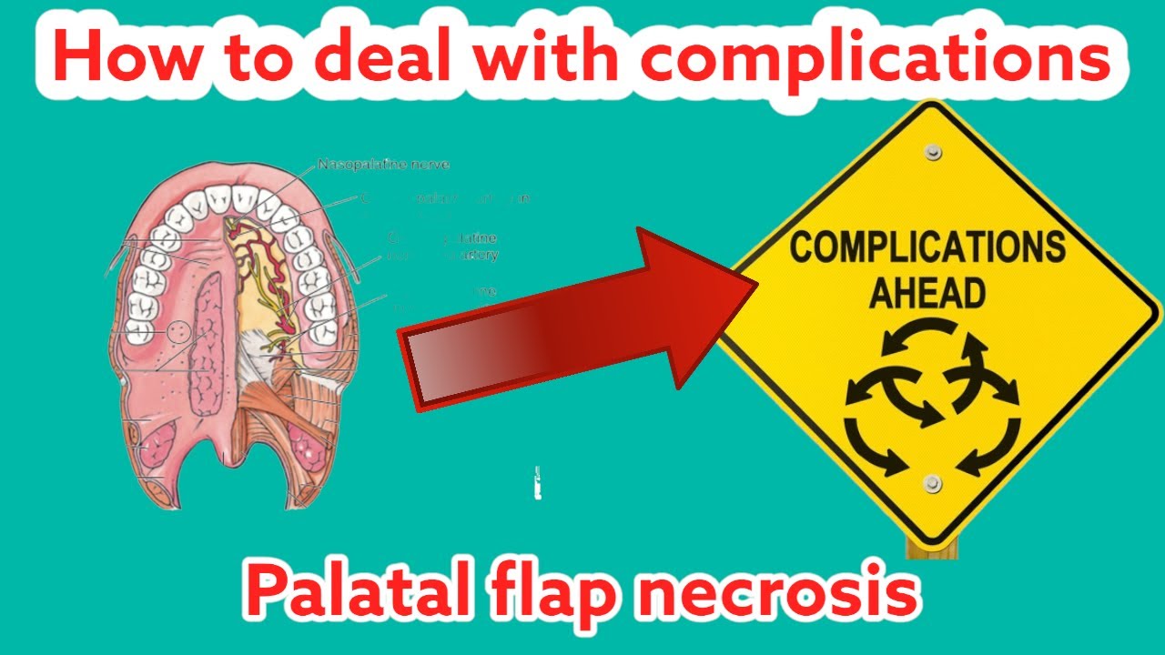 Palatal flap necrosis , complication after eating spicy food after ...