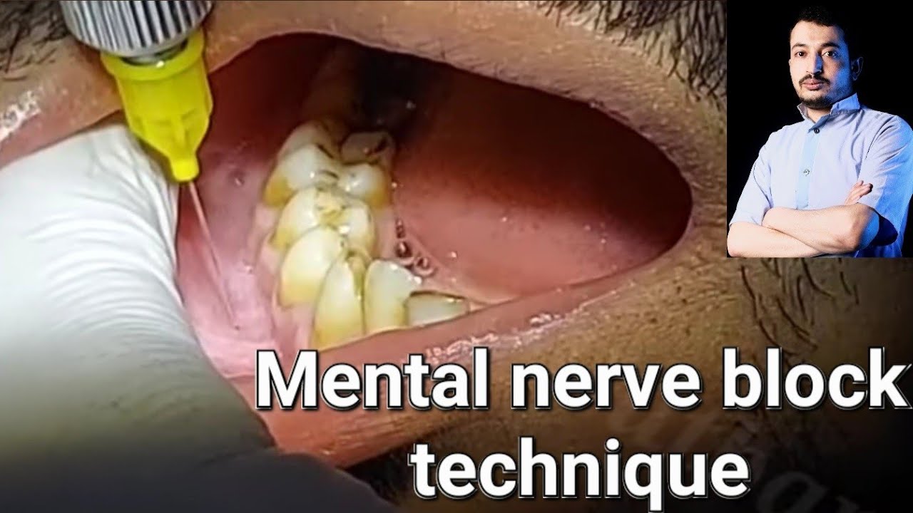 Local Anesthesia, Mental Nerve block technique, Mandibular Anesthesia ...