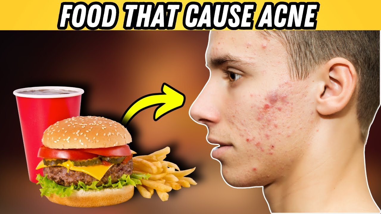 FOOD THAT CAUSE ACNE / WHY YOU HAVE ACNE - STOP EATING THOSE FOODS IF ...